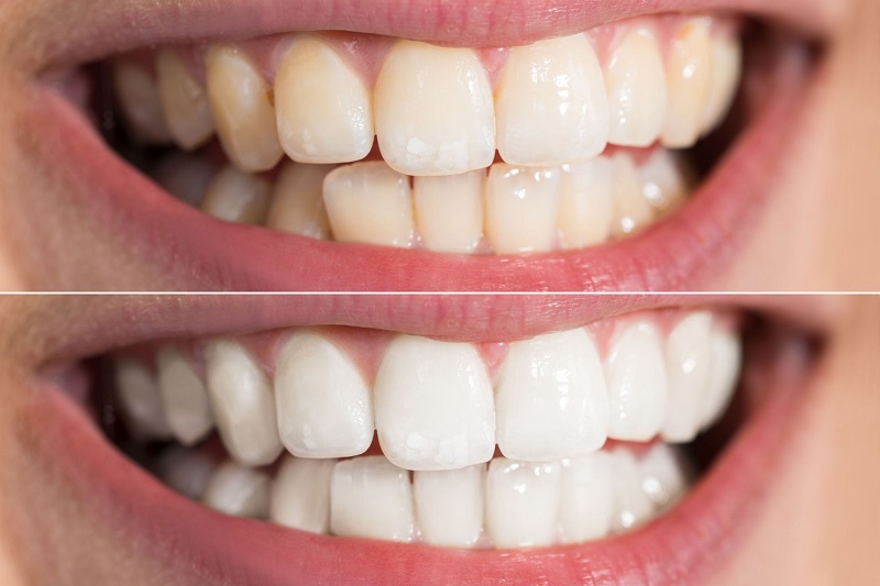 Kucukcekmece Tooth Bleaching - Toorh Bleaching Treatment | Sefakoy